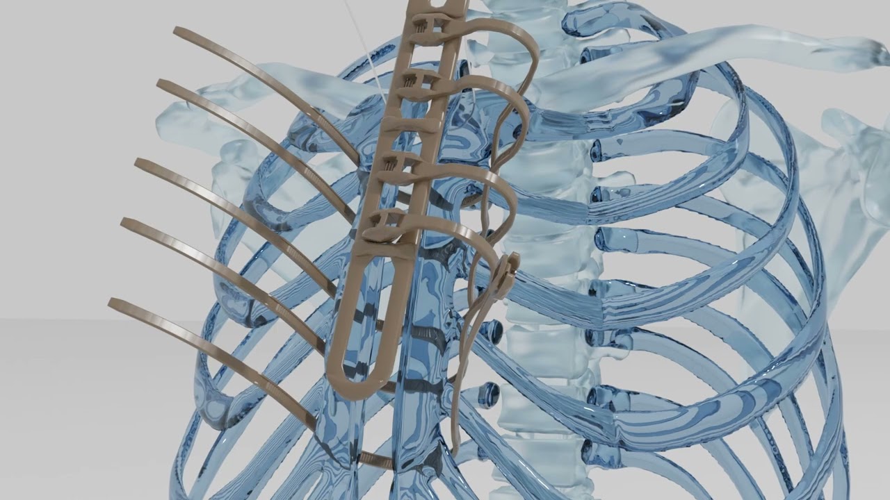 A New Approach to Rigid Sternal Closure - PlasticStar